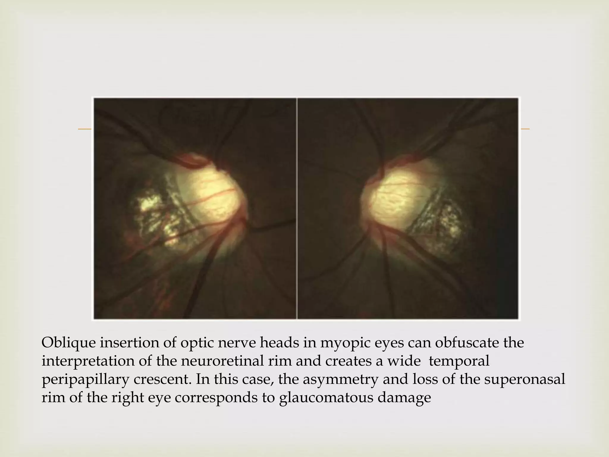 Optic nerve head evaluation in glaucoma | PPTX
