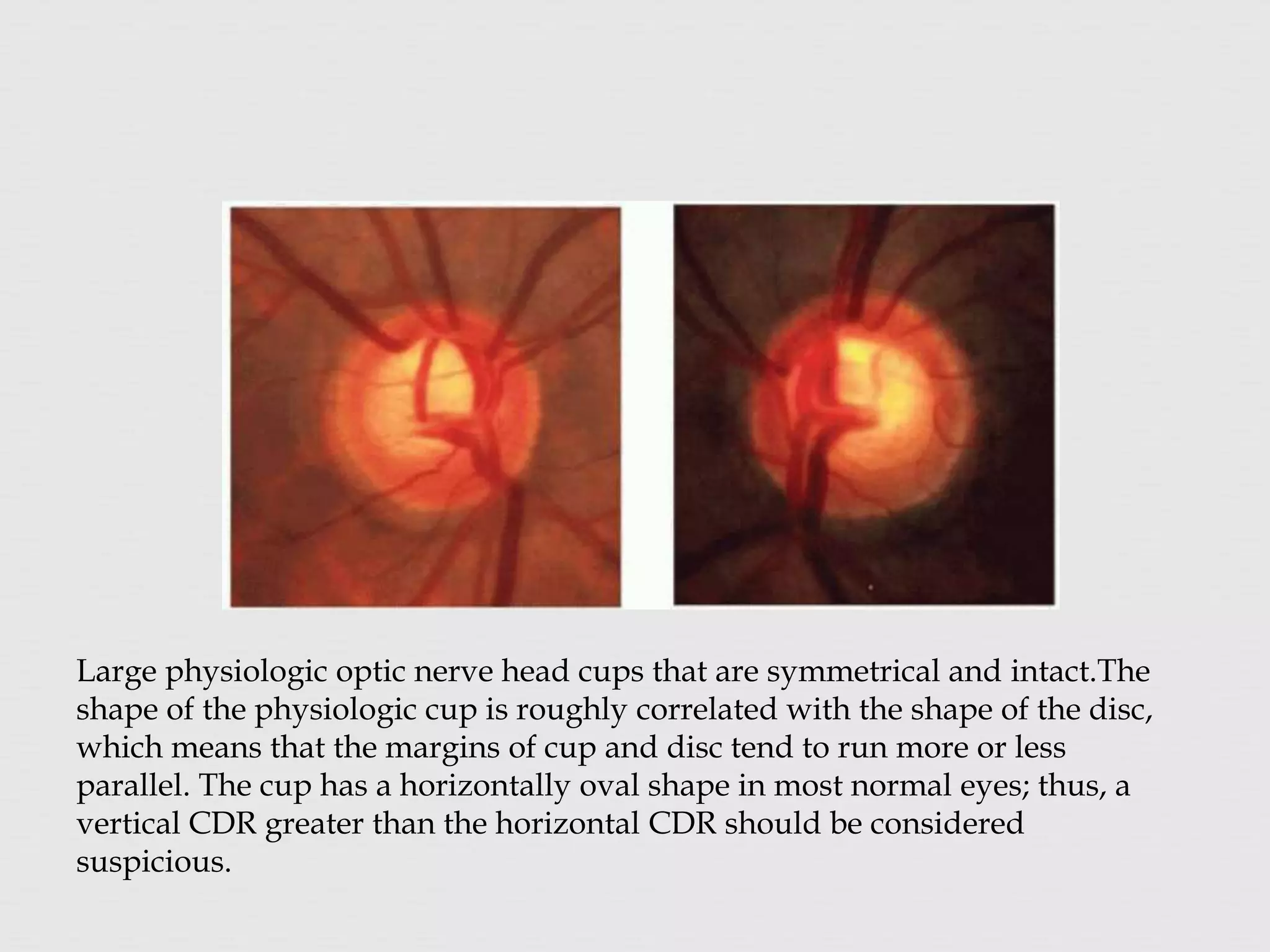 Optic nerve head evaluation in glaucoma | PPTX