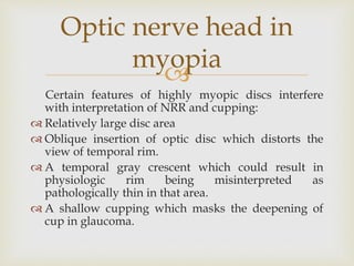 Optic nerve head evaluation in glaucoma | PPTX