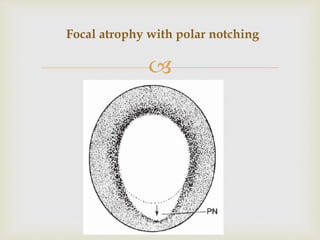 Optic nerve head evaluation in glaucoma | PPTX | Eye and Vision ...