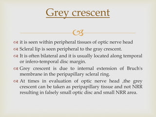 Peripapillary Crescent