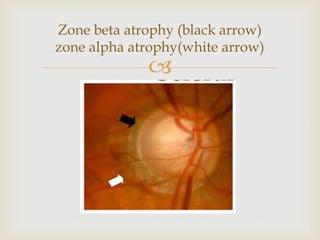 Peripapillary Atrophy In Glaucoma