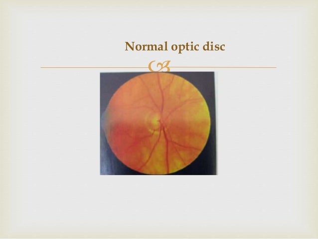 Optic nerve head evaluation in glaucoma