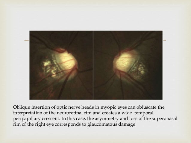Optic nerve head evaluation in glaucoma