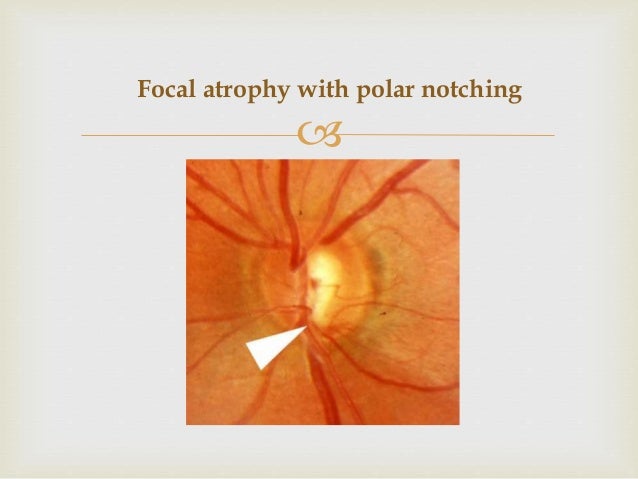 Optic nerve head evaluation in glaucoma