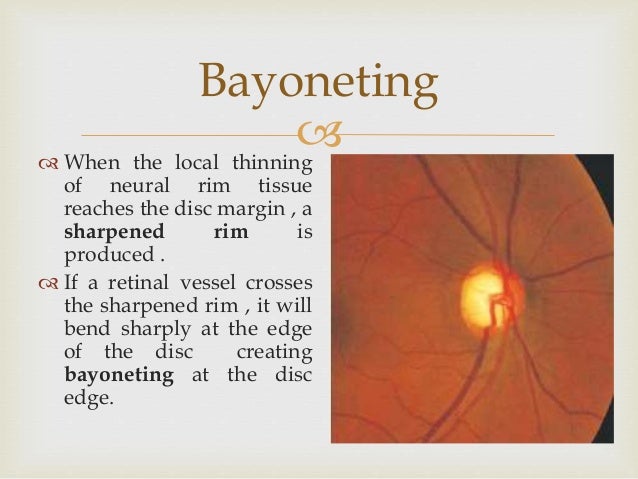 Optic nerve head evaluation in glaucoma
