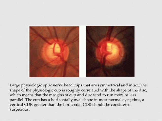 Optic nerve head evaluation in glaucoma