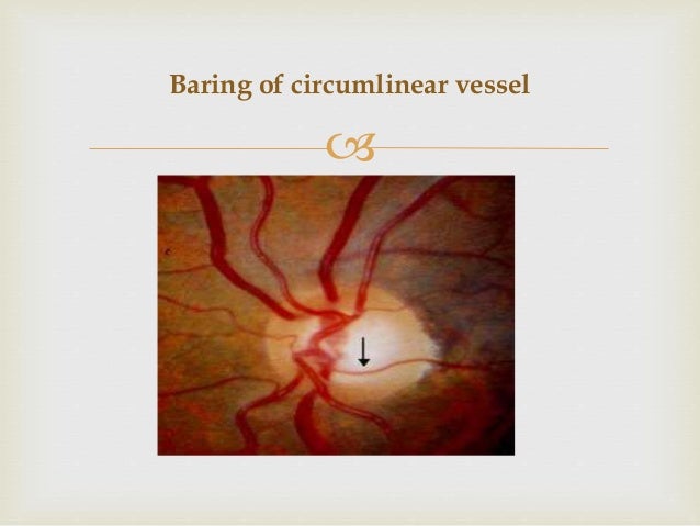 Optic nerve head evaluation in glaucoma