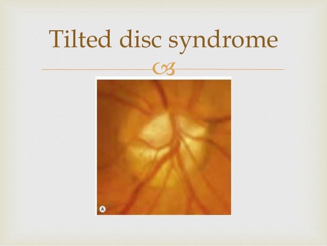 Optic nerve head evaluation in glaucoma