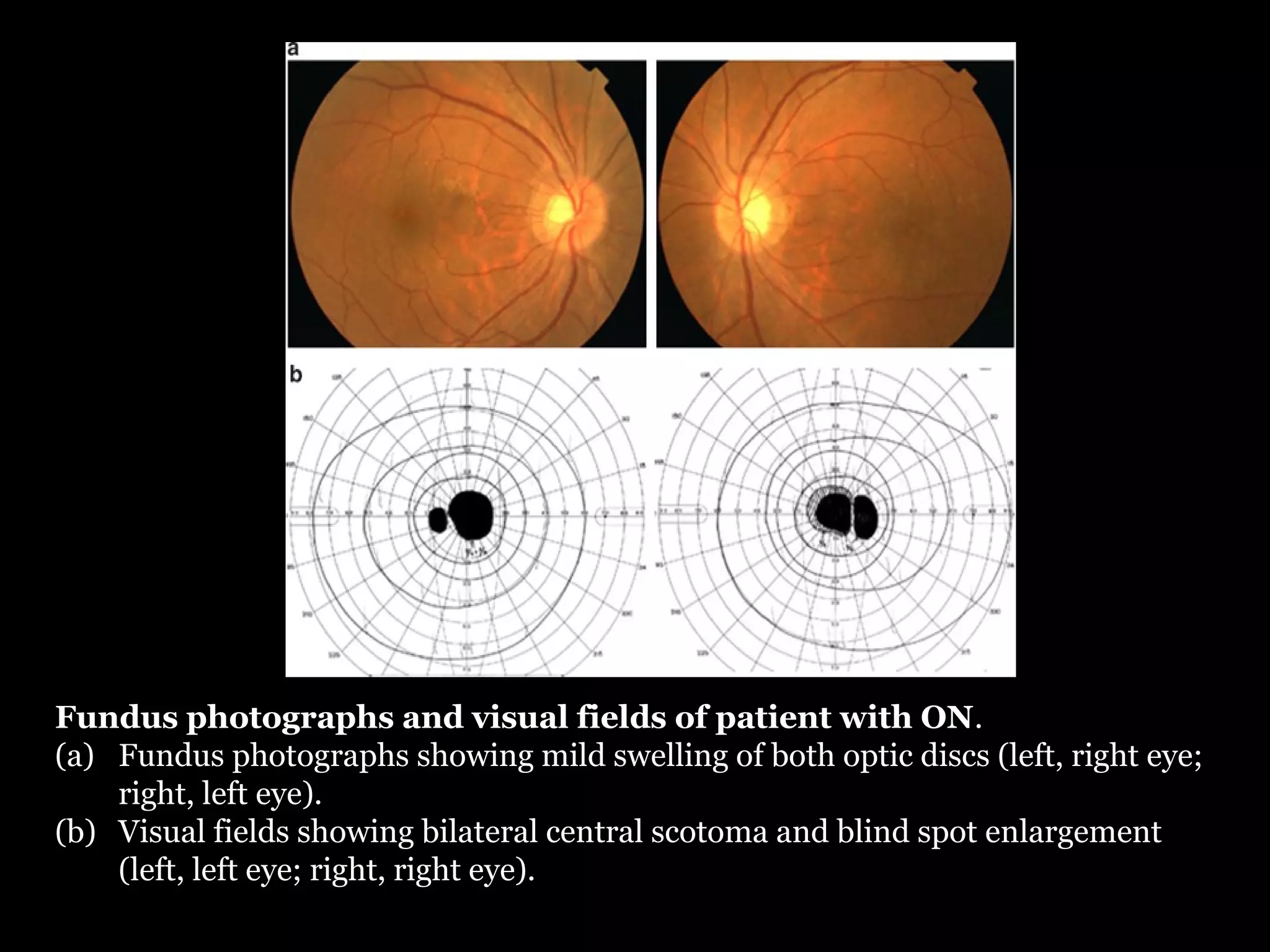 Optic nerve Diseases By: Sumayya Naseem Optometrist | PPS