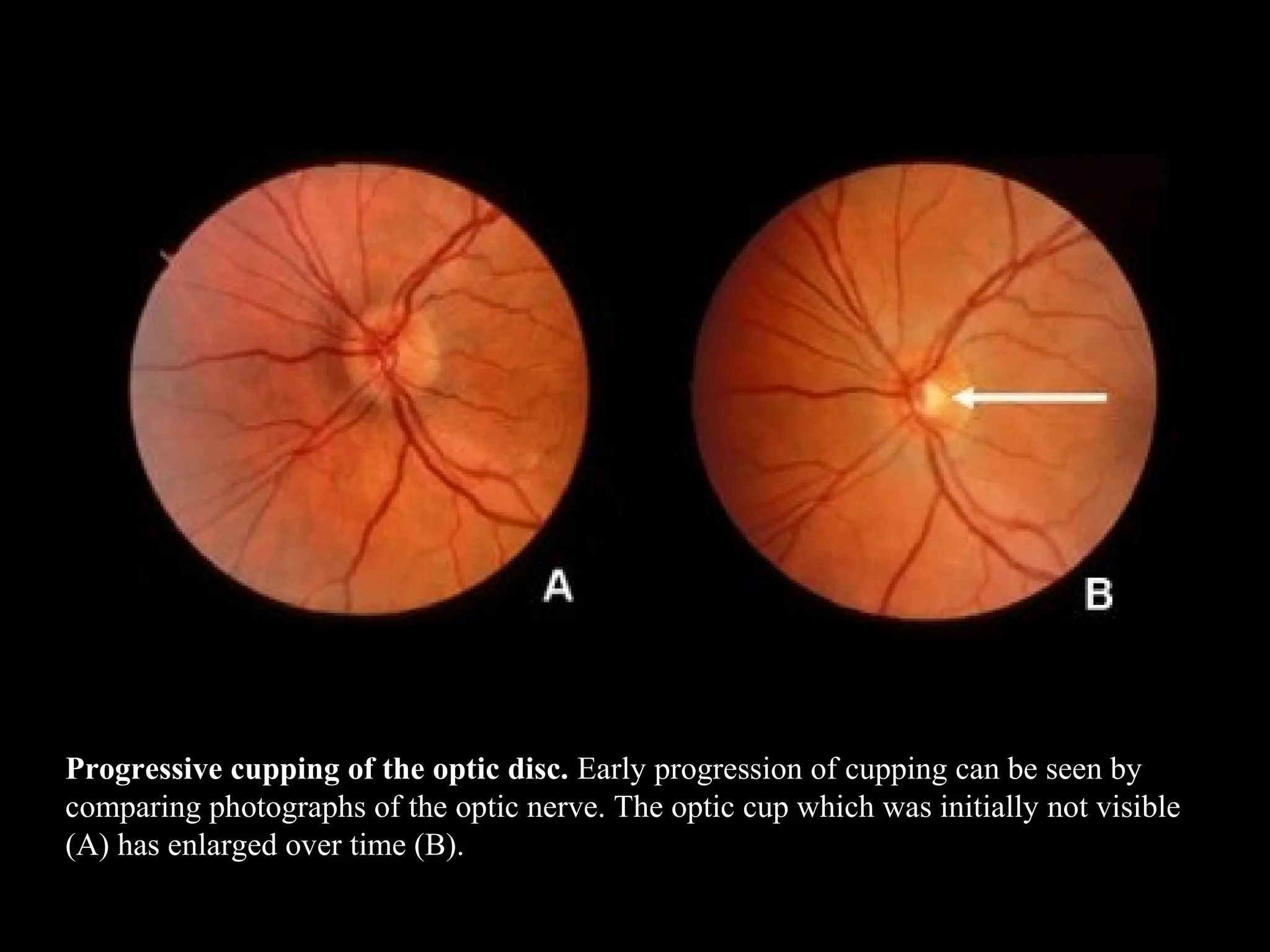 Optic nerve Diseases By: Sumayya Naseem Optometrist | PPS