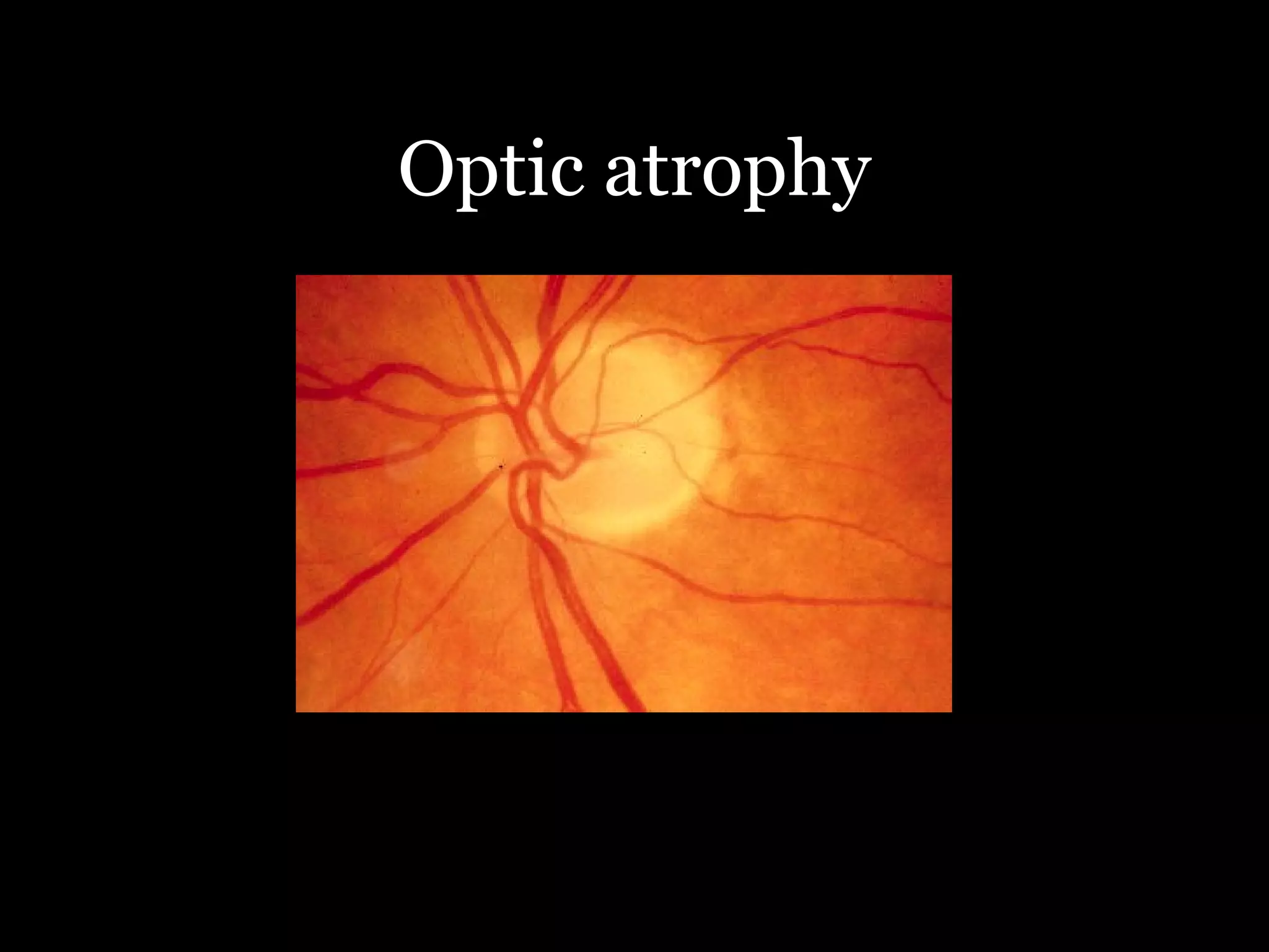 Optic nerve Diseases By: Sumayya Naseem Optometrist | PPS
