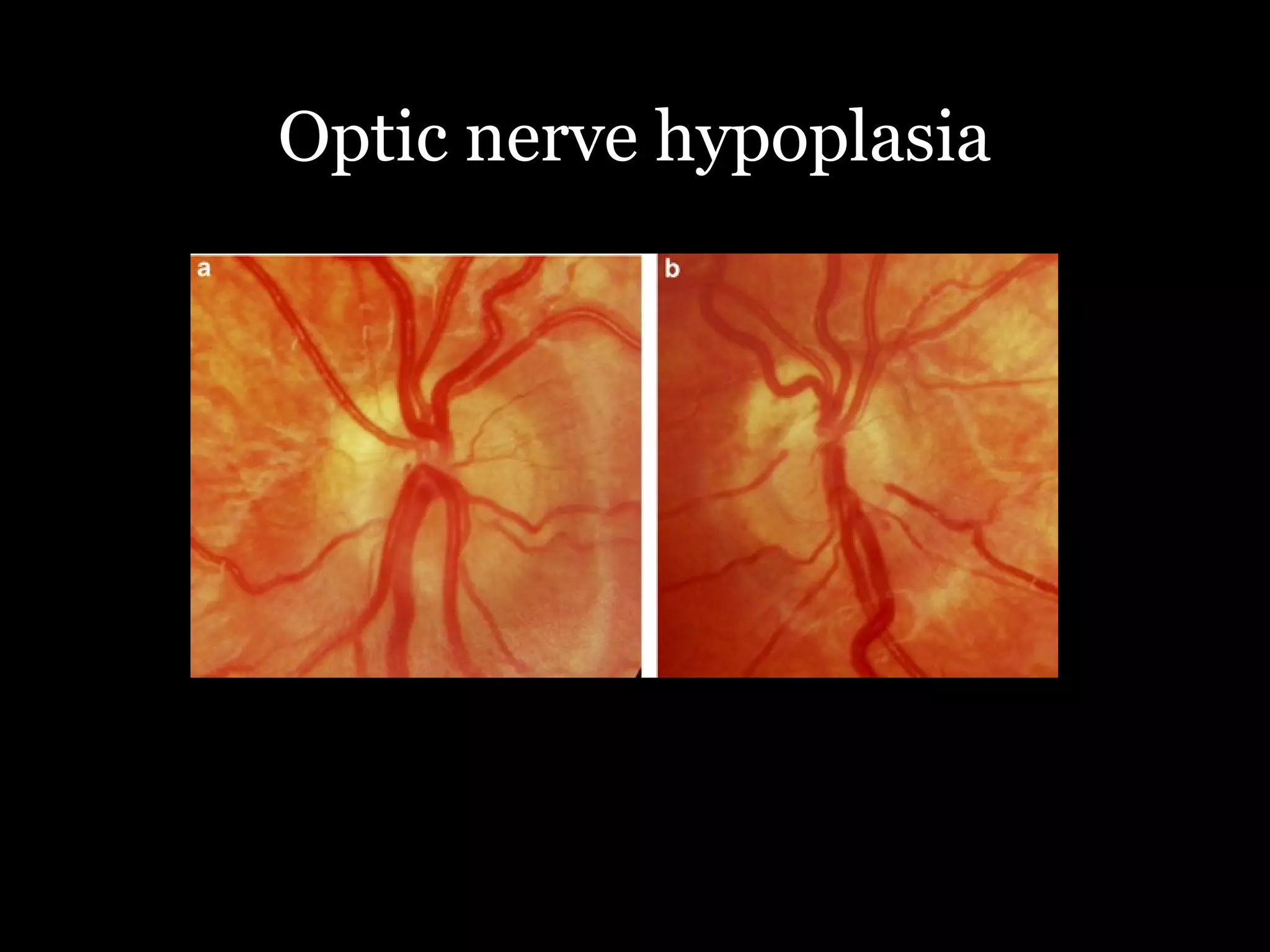 Optic nerve Diseases By: Sumayya Naseem Optometrist | PPS