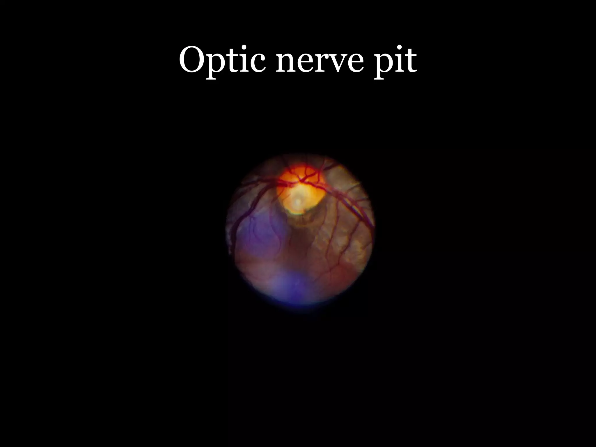 Optic nerve Diseases By: Sumayya Naseem Optometrist | PPS