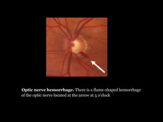 Optic nerve Diseases By: Sumayya Naseem Optometrist | PPT