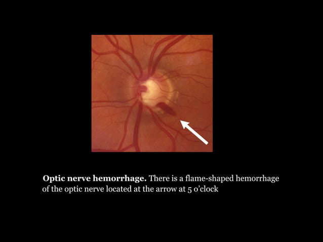 Optic nerve Diseases By: Sumayya Naseem Optometrist | PPT