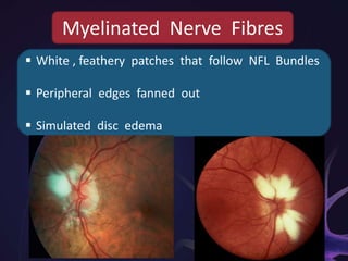 Anatomy of Optic Nerve | PPTX