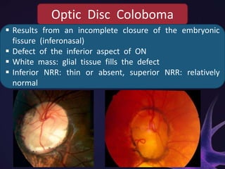 Choroidal Crescent Optic Disc