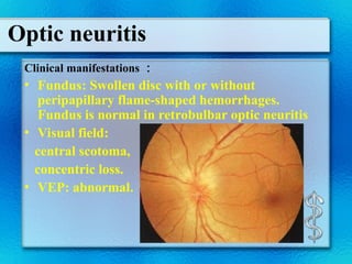 OPtic nerve OK Neuro-ophthalmology for MBBs | PPT