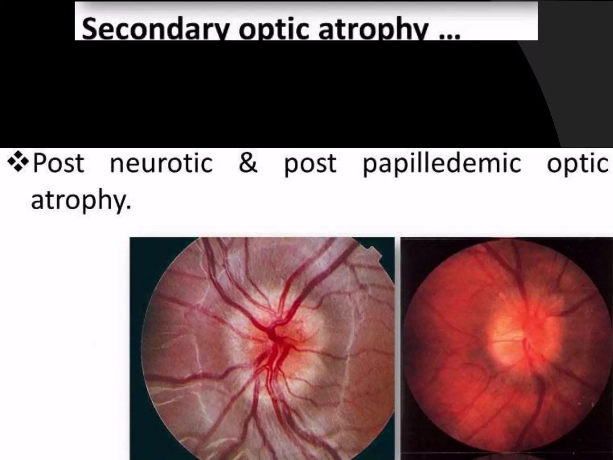 Optic nerve optic atrophy Clinical Round | PPT