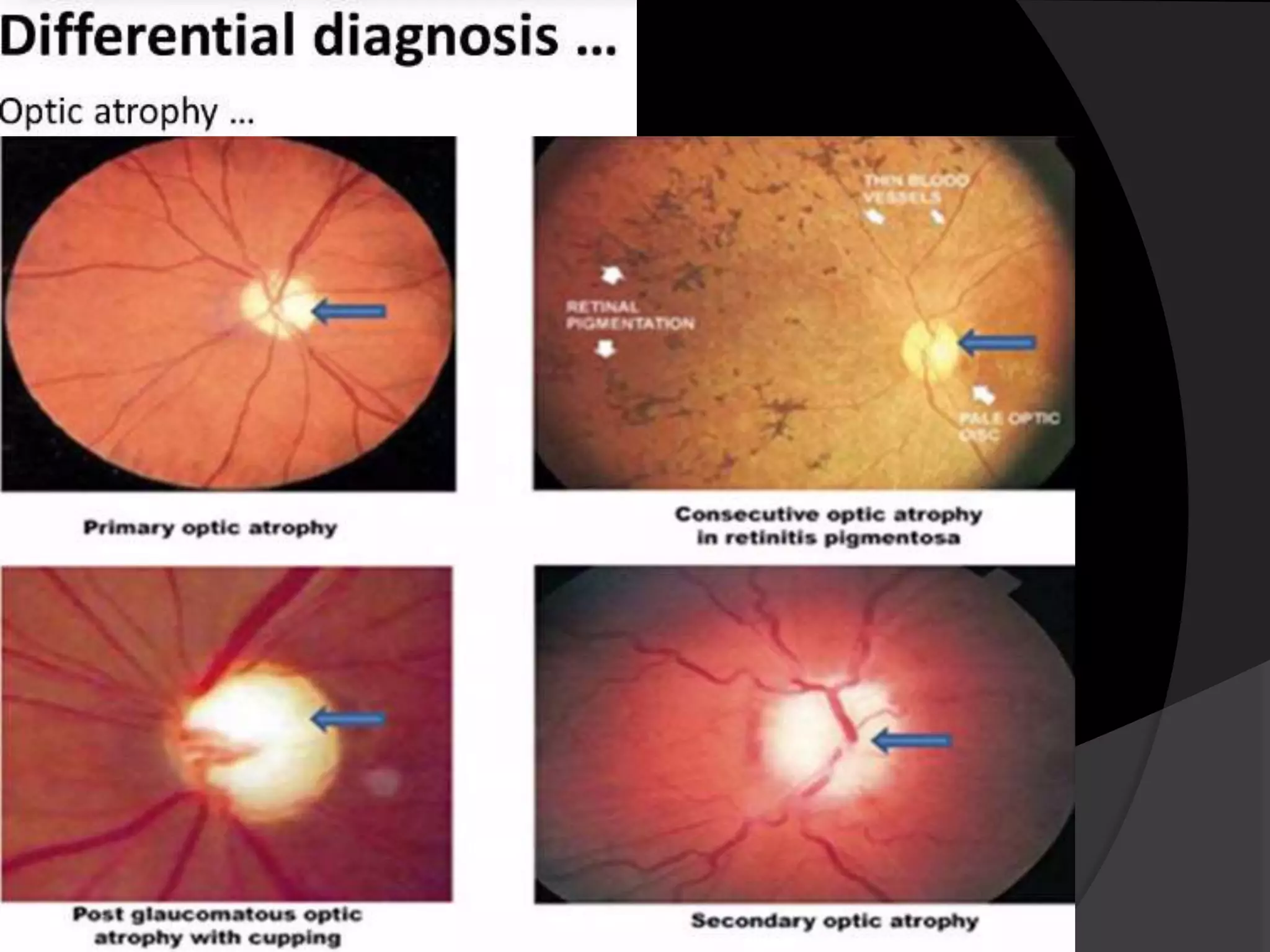 Optic nerve optic atrophy Clinical Round | PPT