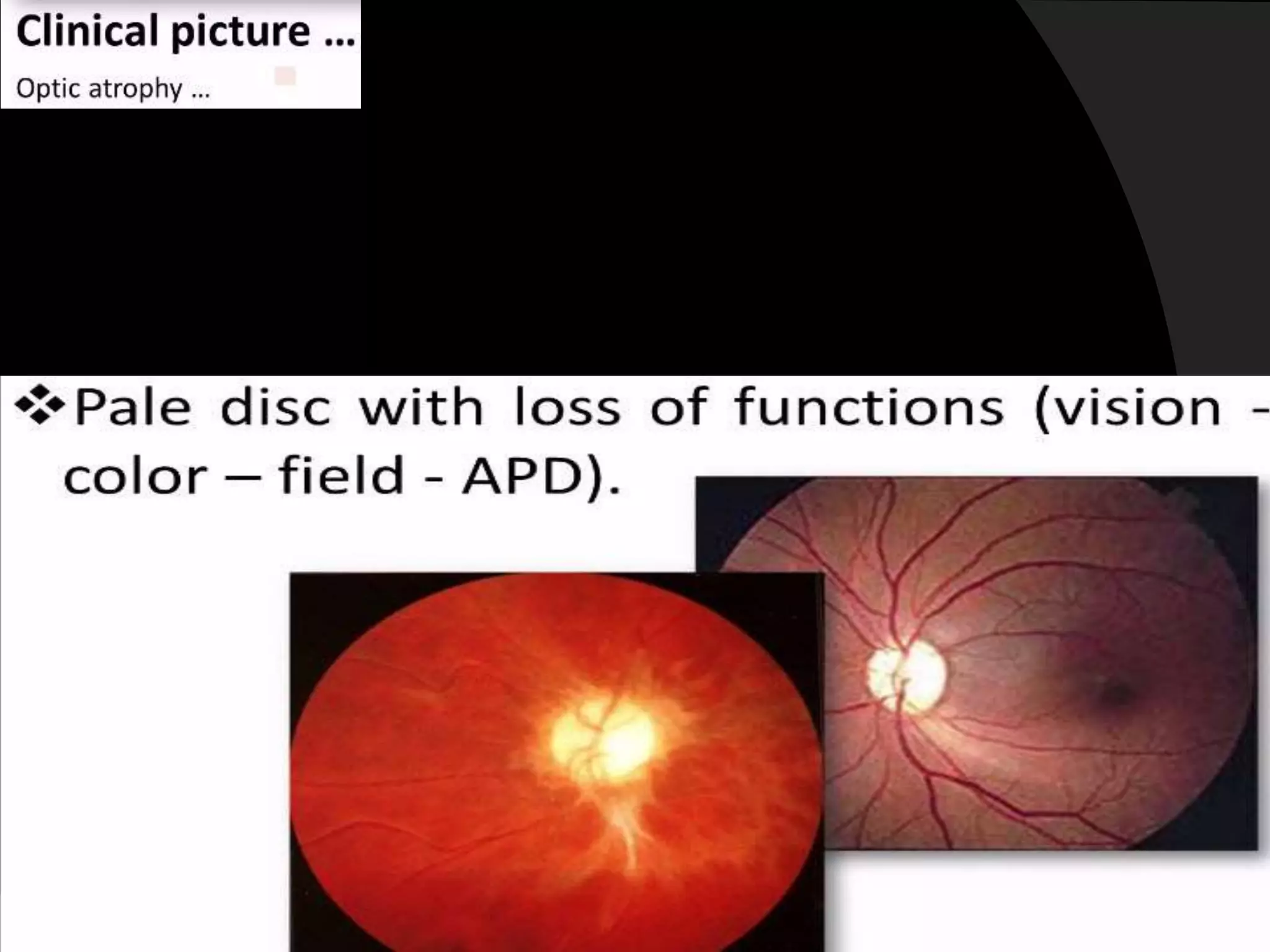 Optic nerve optic atrophy Clinical Round | PPT