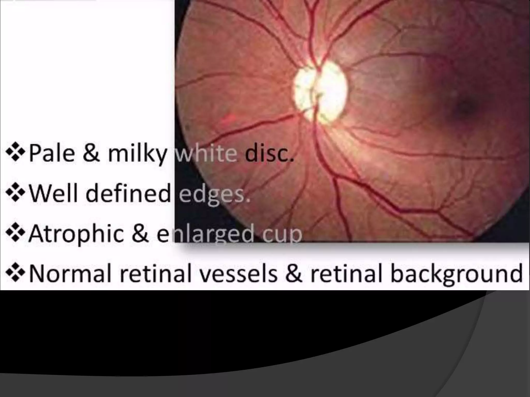 Optic nerve optic atrophy Clinical Round | PPT