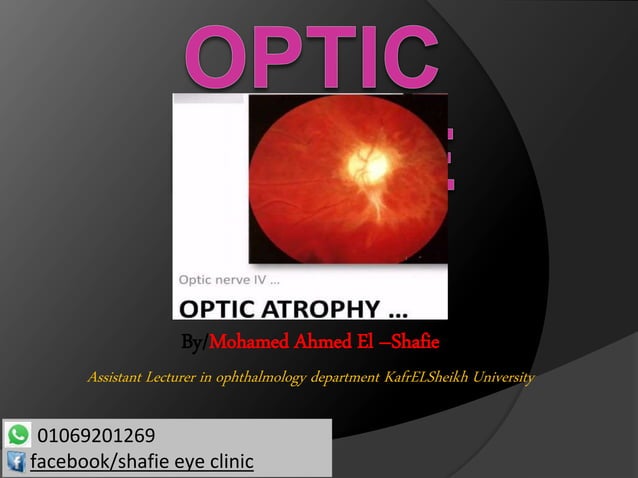 Optic nerve optic atrophy Clinical Round | PPT
