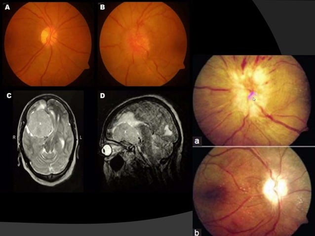 Optic nerve optic atrophy Clinical Round | PPT