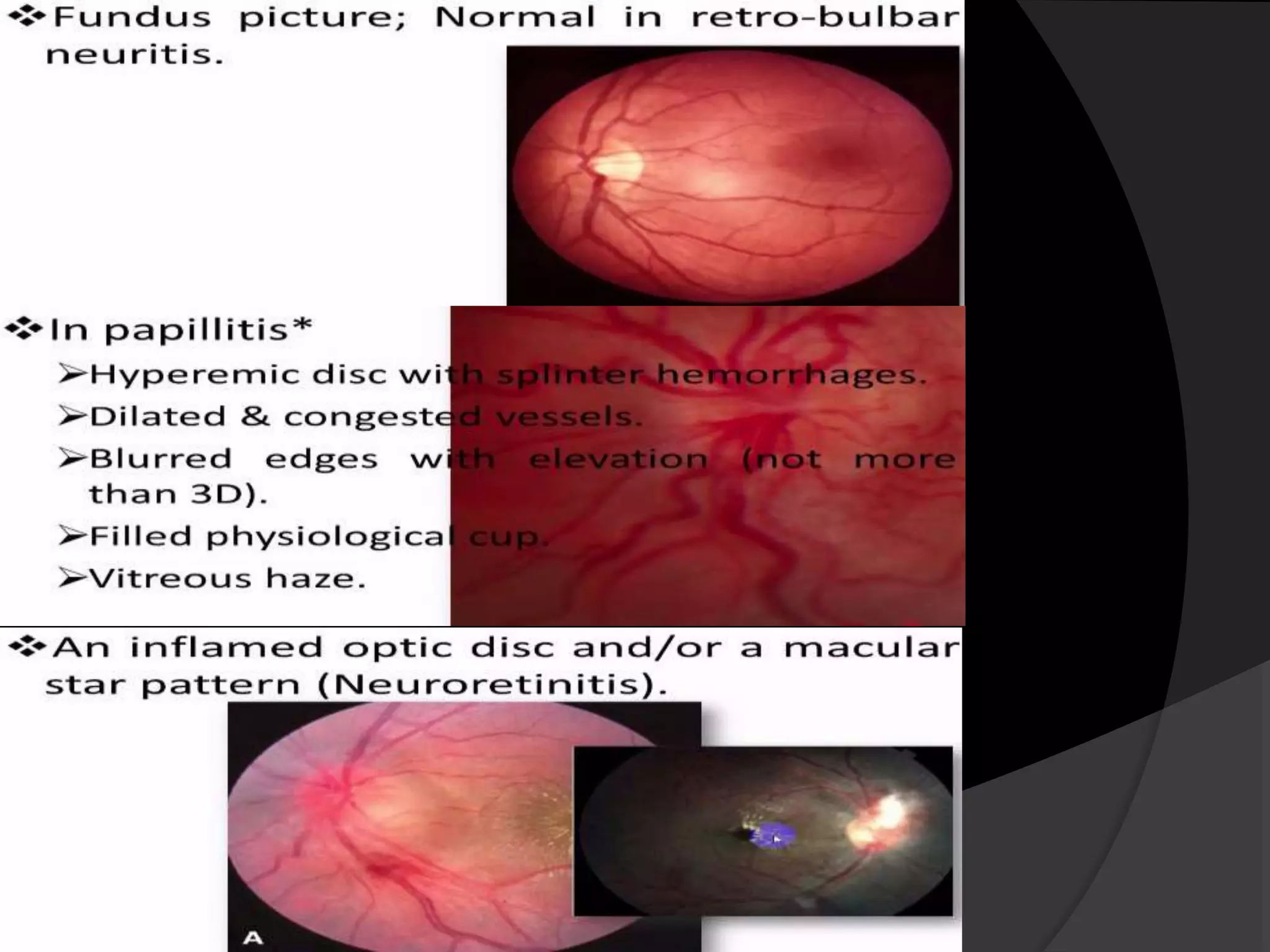 Optic nerve optic neuritis Clinical round | PPTX