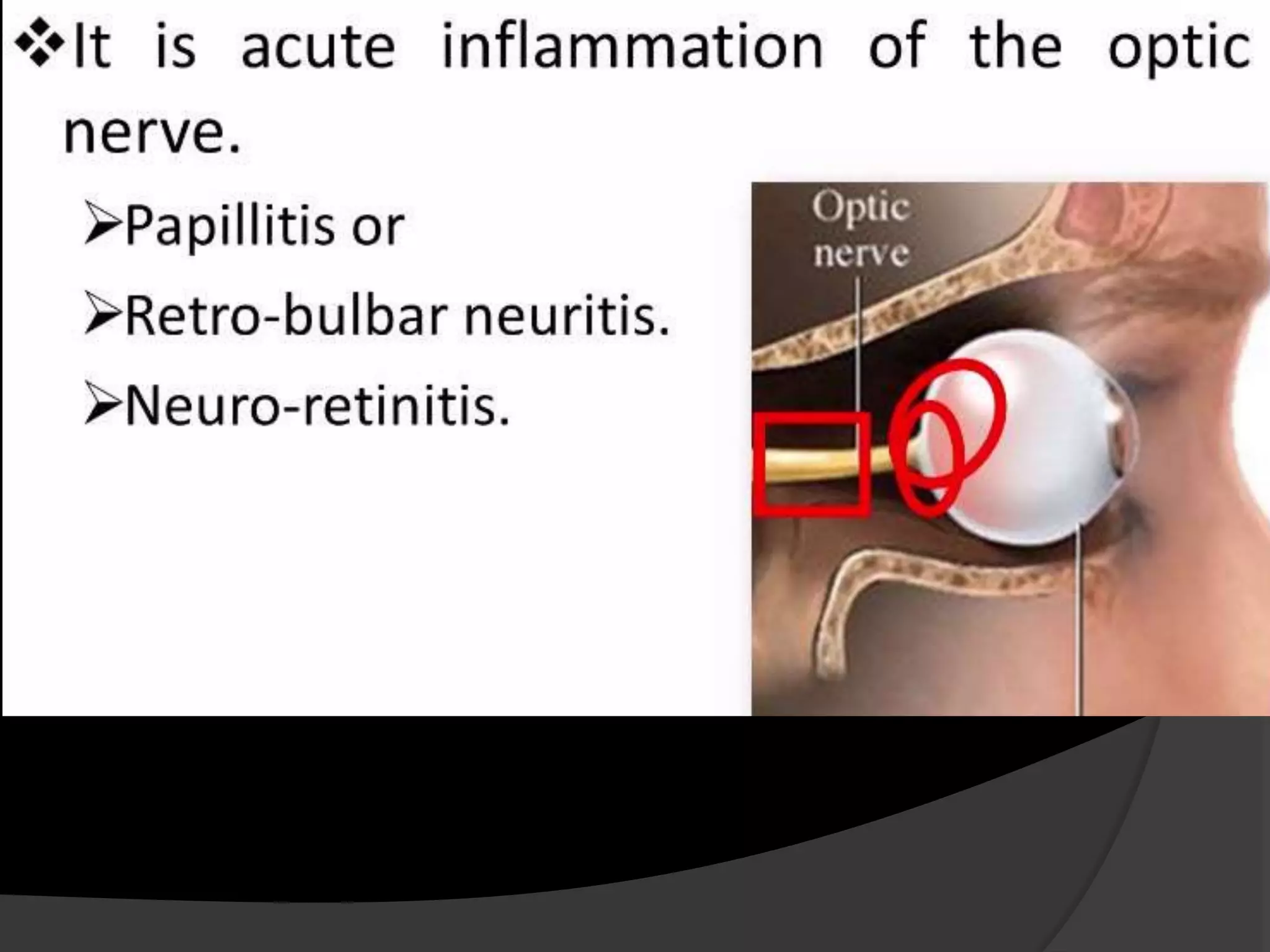 Optic nerve optic neuritis Clinical round | PPTX