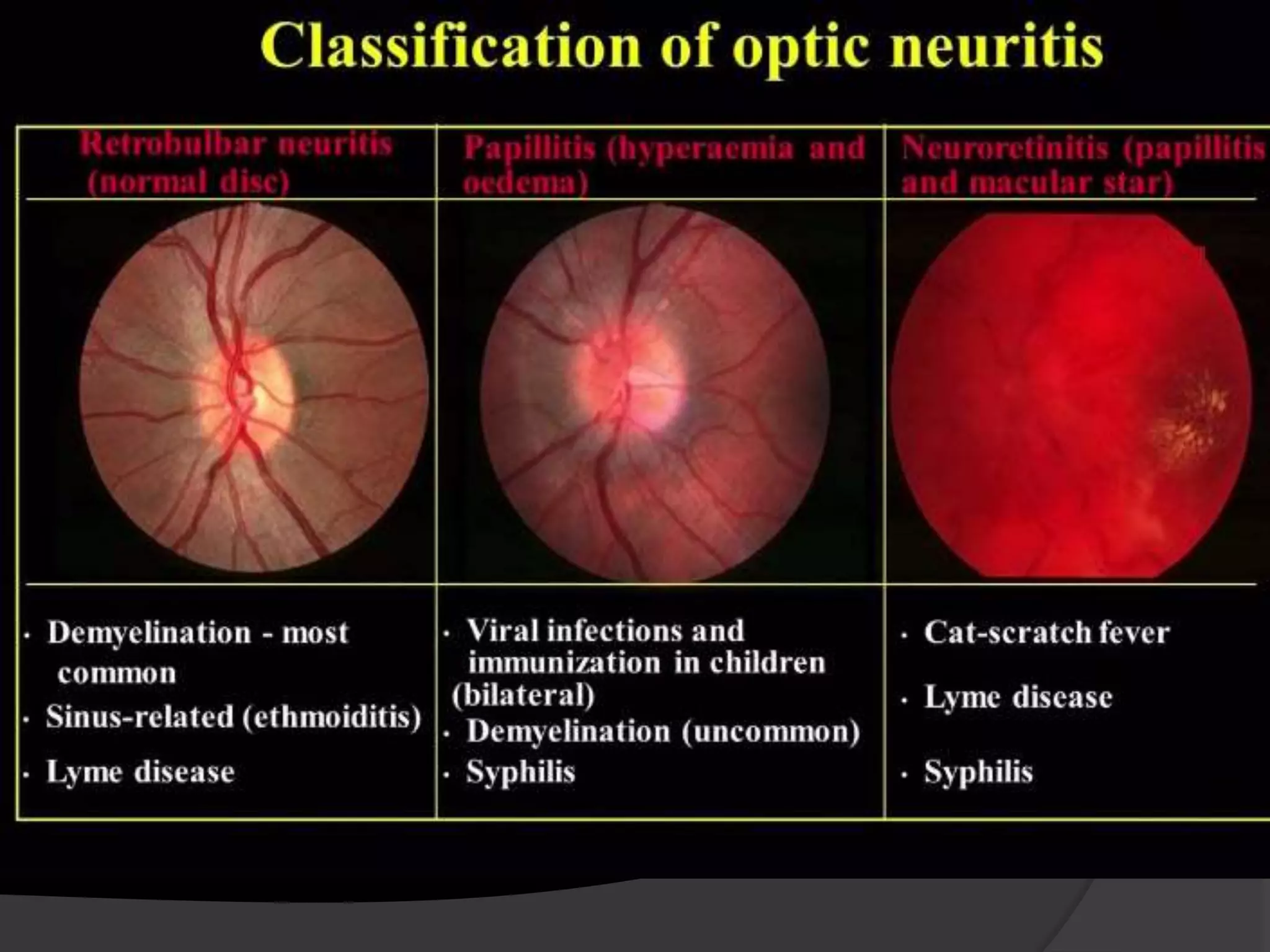 Optic nerve optic neuritis Clinical round | PPTX | Eye and Vision Conditions | Diseases and ...