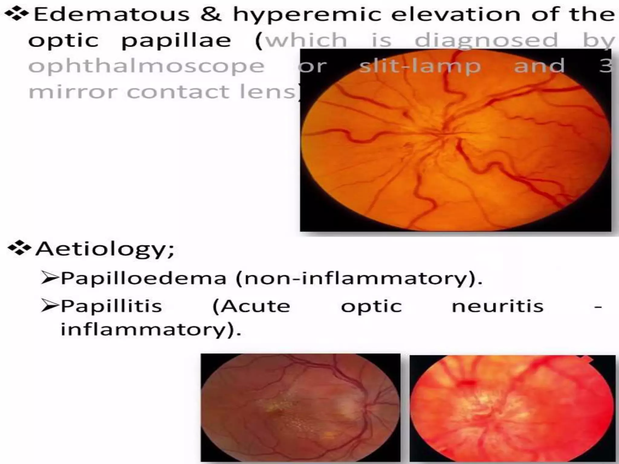 Optic nerve pappiloedema clinical round | PPT