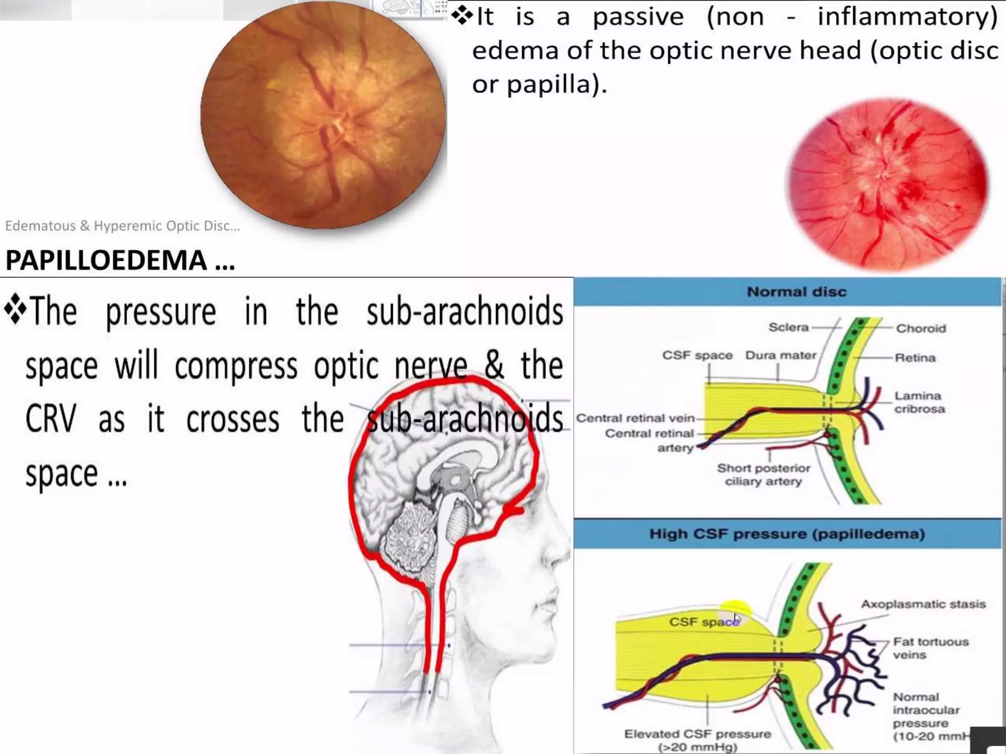 Optic nerve pappiloedema clinical round | PPT