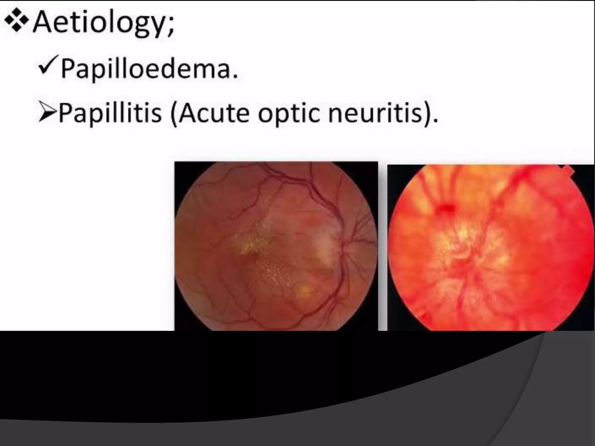 Optic nerve pappiloedema clinical round | PPT