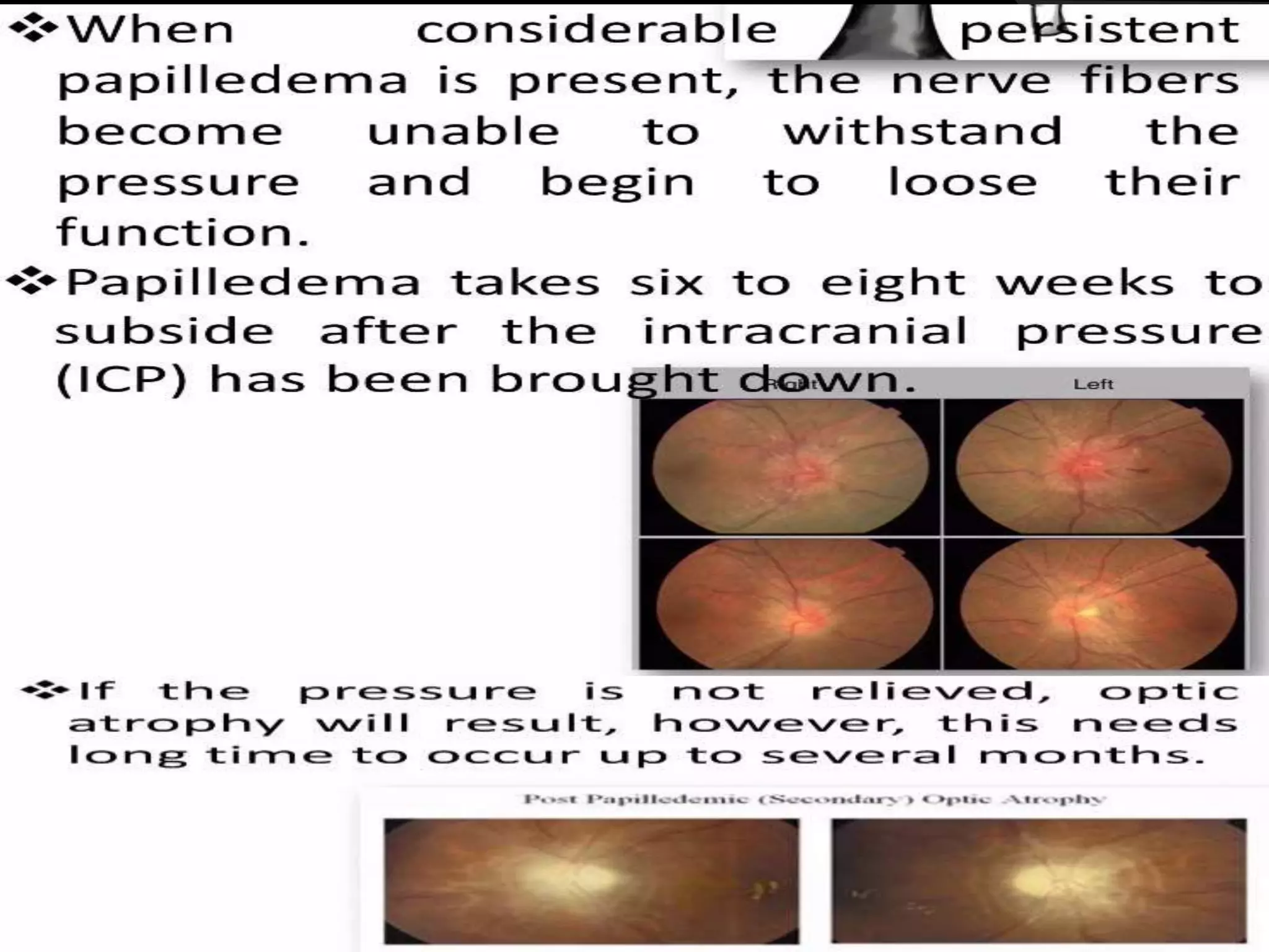 Optic nerve pappiloedema clinical round | PPT
