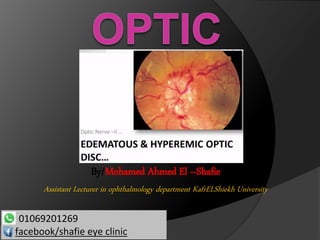 Optic nerve pappiloedema clinical round | PPT