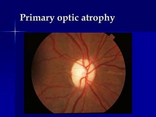 Optic nerve revision | PPT