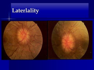 Optic nerve revision | PPT