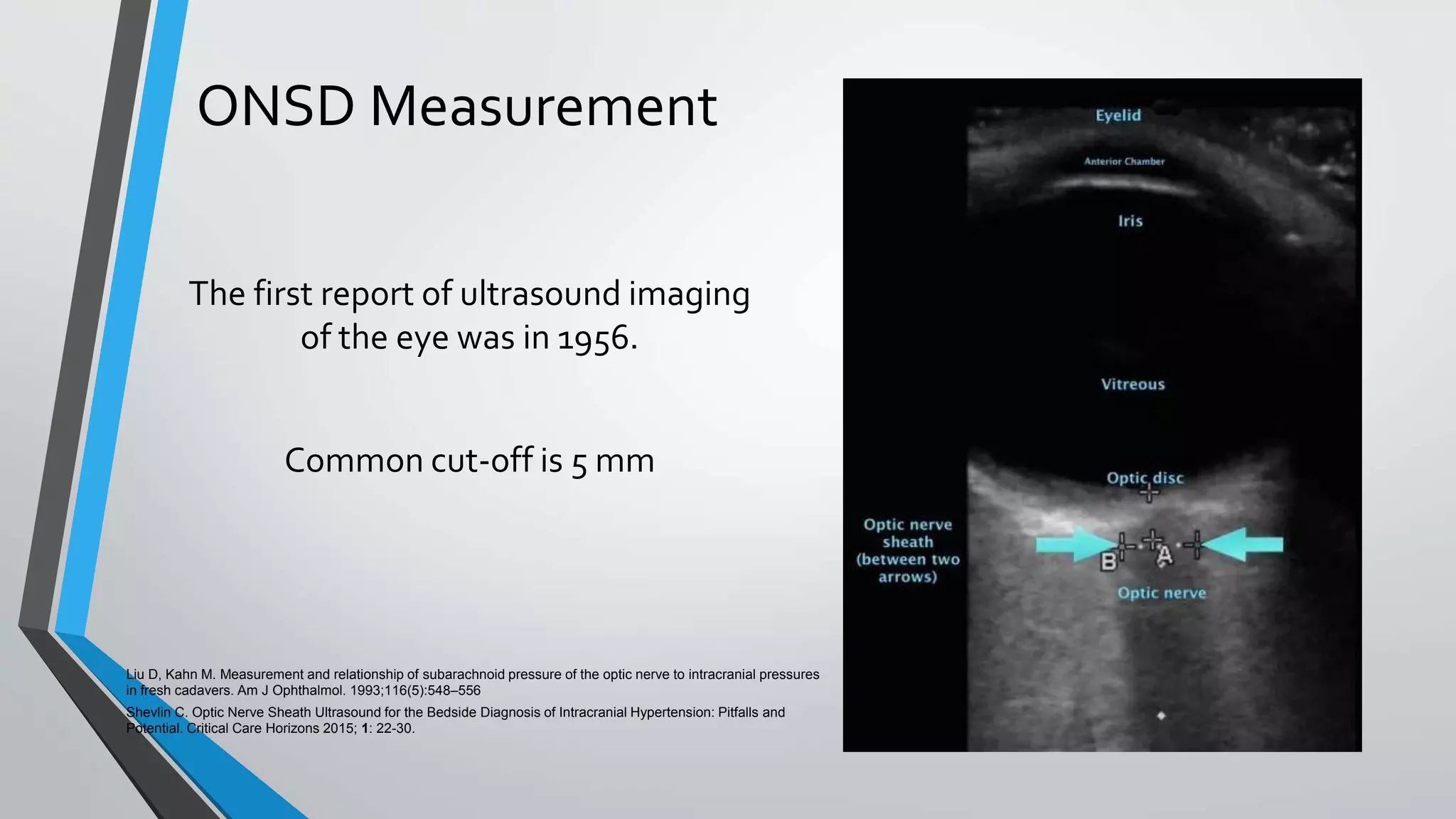 Optic Nerve Sheath Diameter (ONSD) Measurement for Intracranial ...