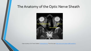 Optic Nerve Sheath Diameter (ONSD) Measurement for Intracranial ...