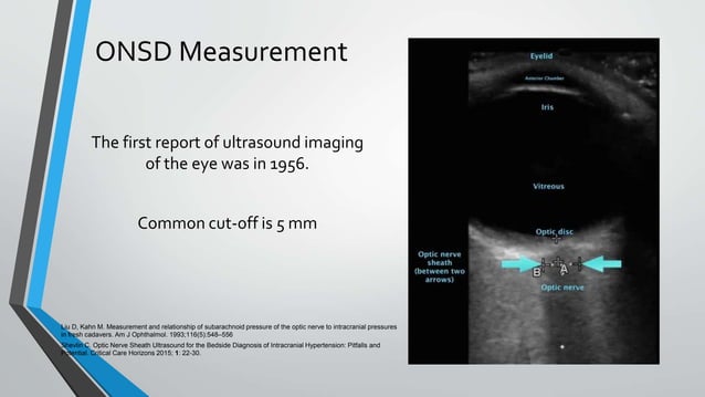 Optic Nerve Sheath Diameter (ONSD) Measurement for Intracranial ...