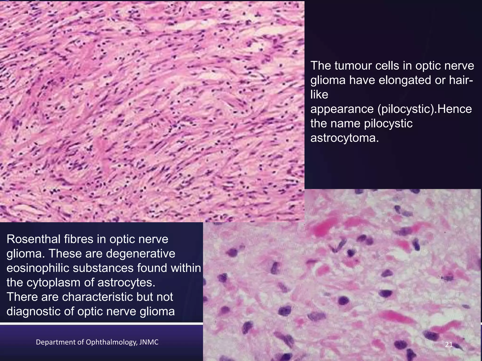 Optic nerve tumors ppt | PPTX