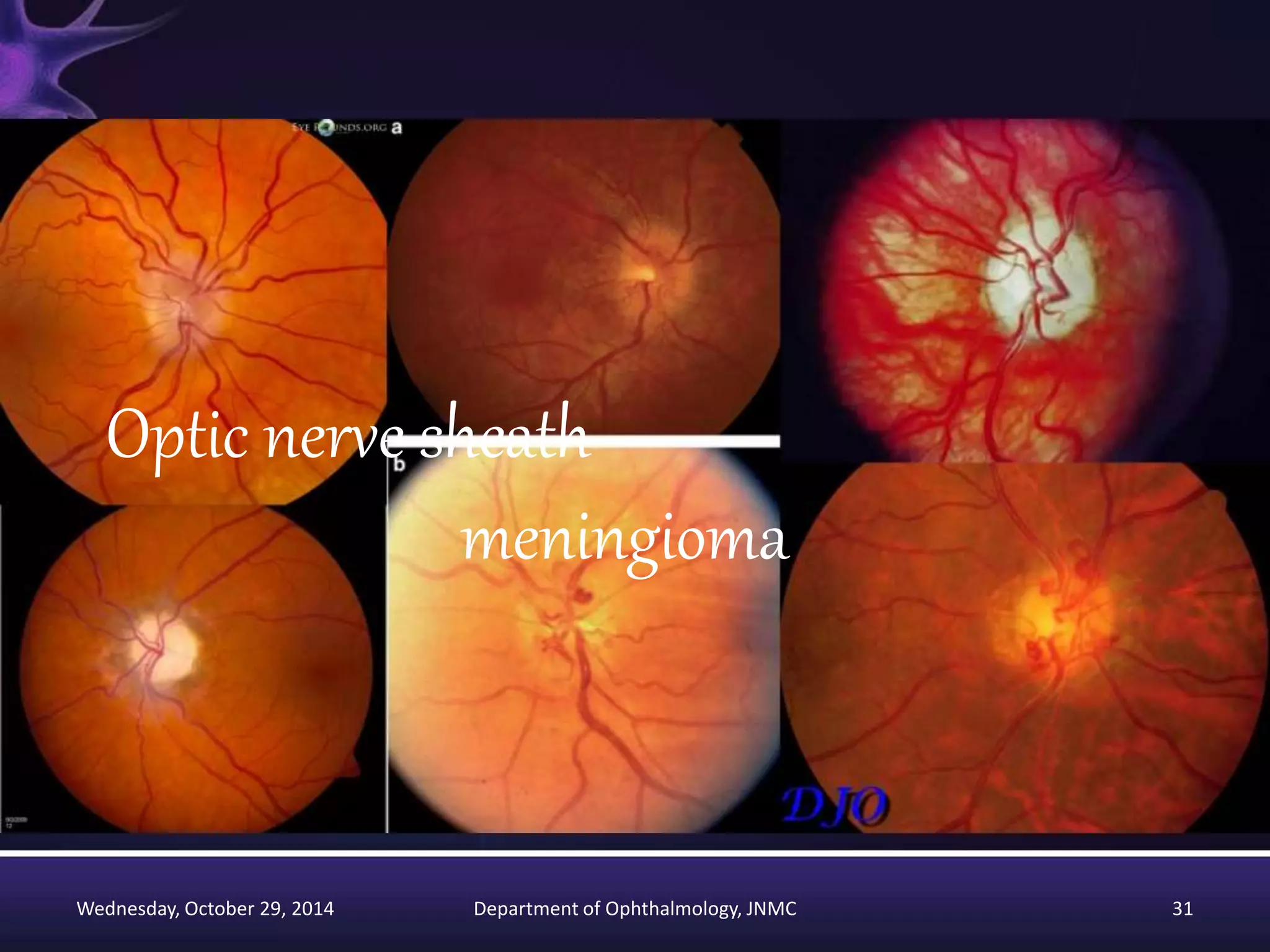 Optic nerve tumors ppt | PPTX