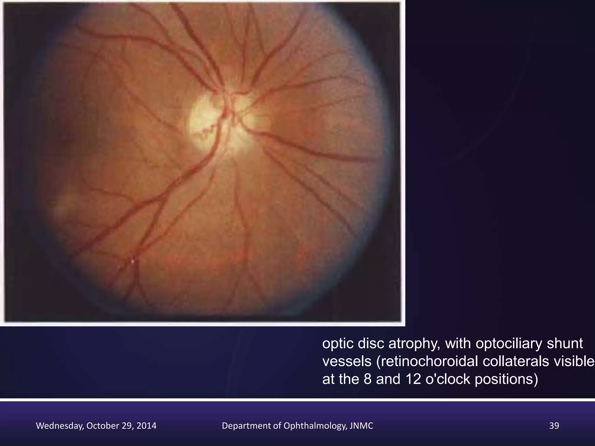 Optic nerve tumors ppt | PPTX