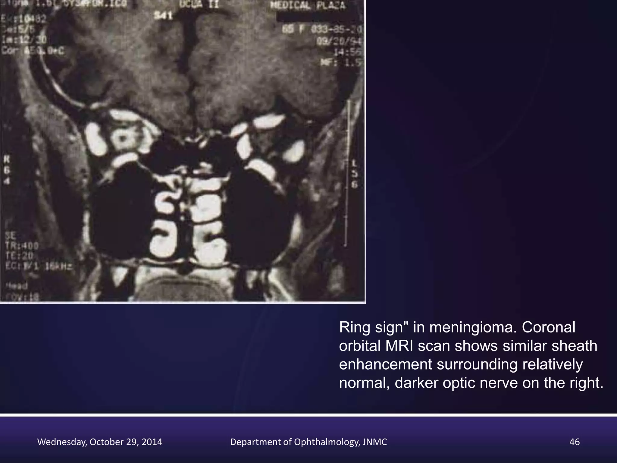Optic nerve tumors ppt | PPTX