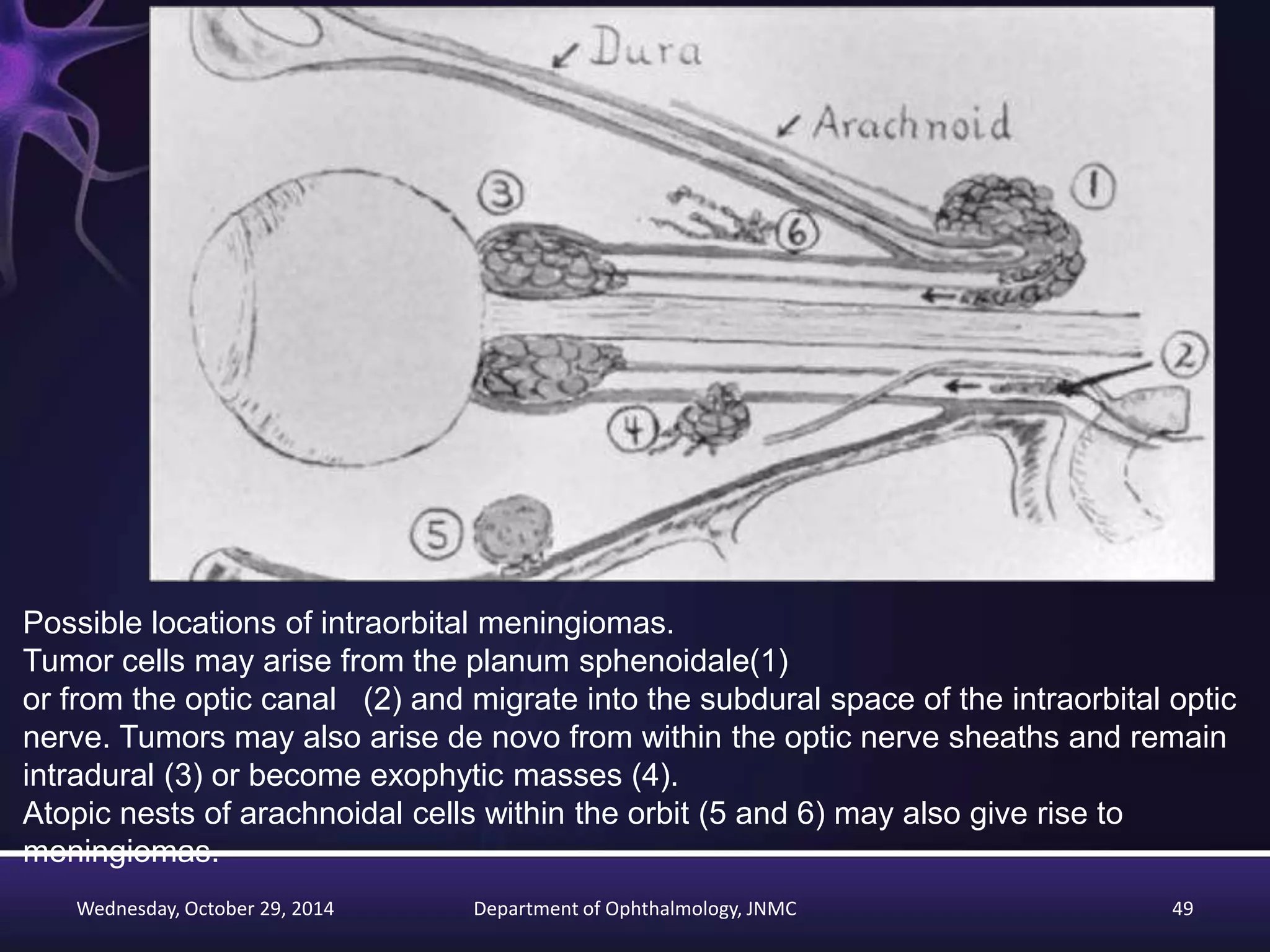 Optic nerve tumors ppt | PPTX