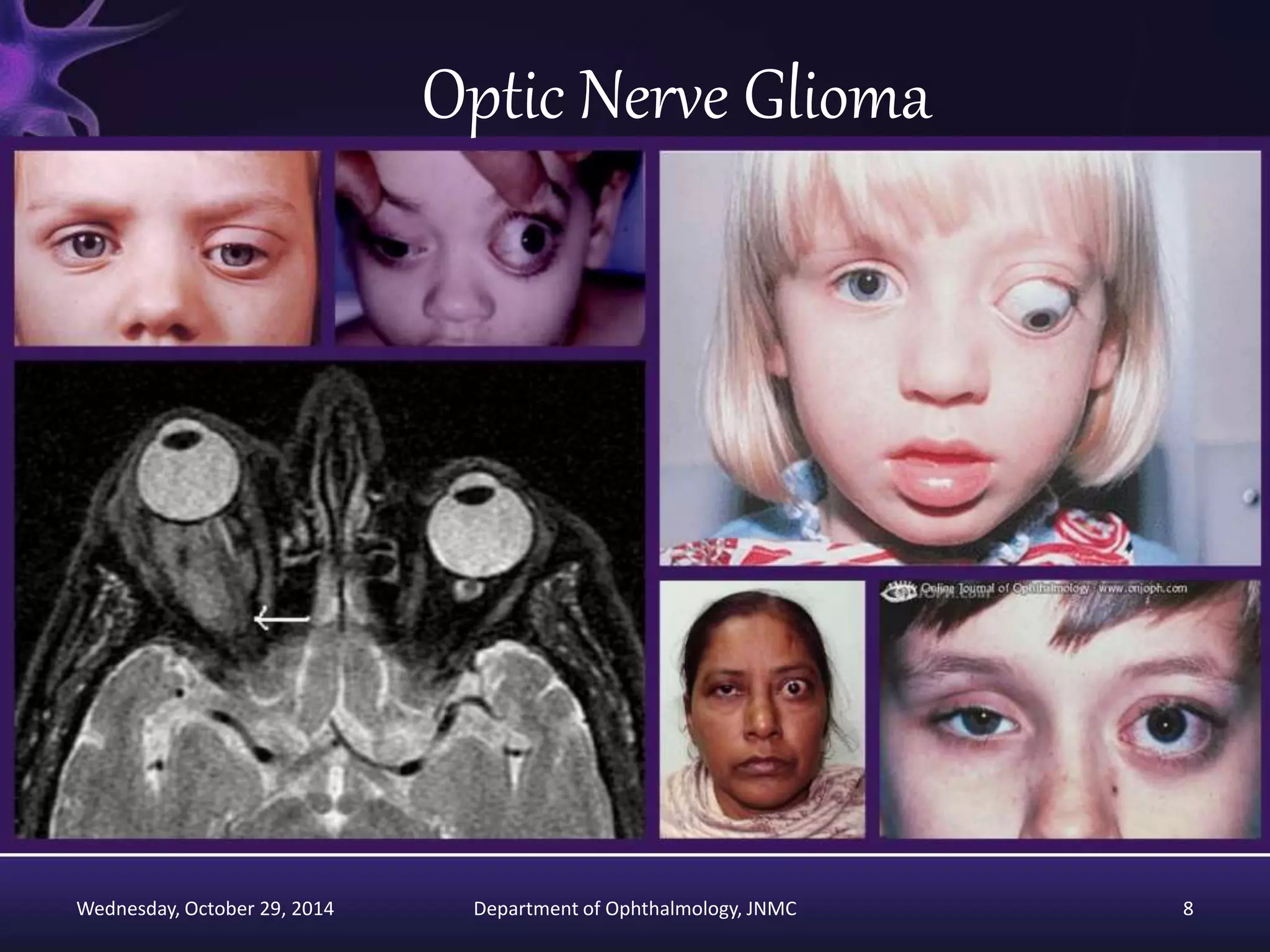Optic nerve tumors ppt | PPTX