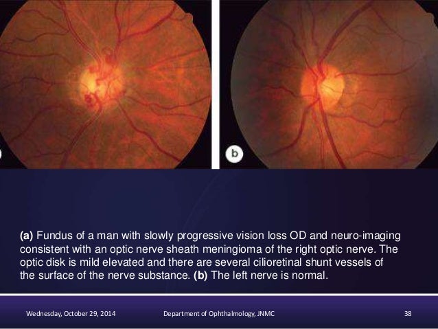 Optic nerve tumors ppt