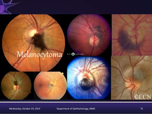 Optic nerve tumors ppt
